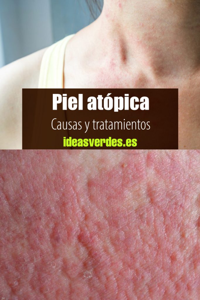 ¿Qué Es La Piel Atópica? Síntomas Causas Y Tratamientos - Ideas Verdes